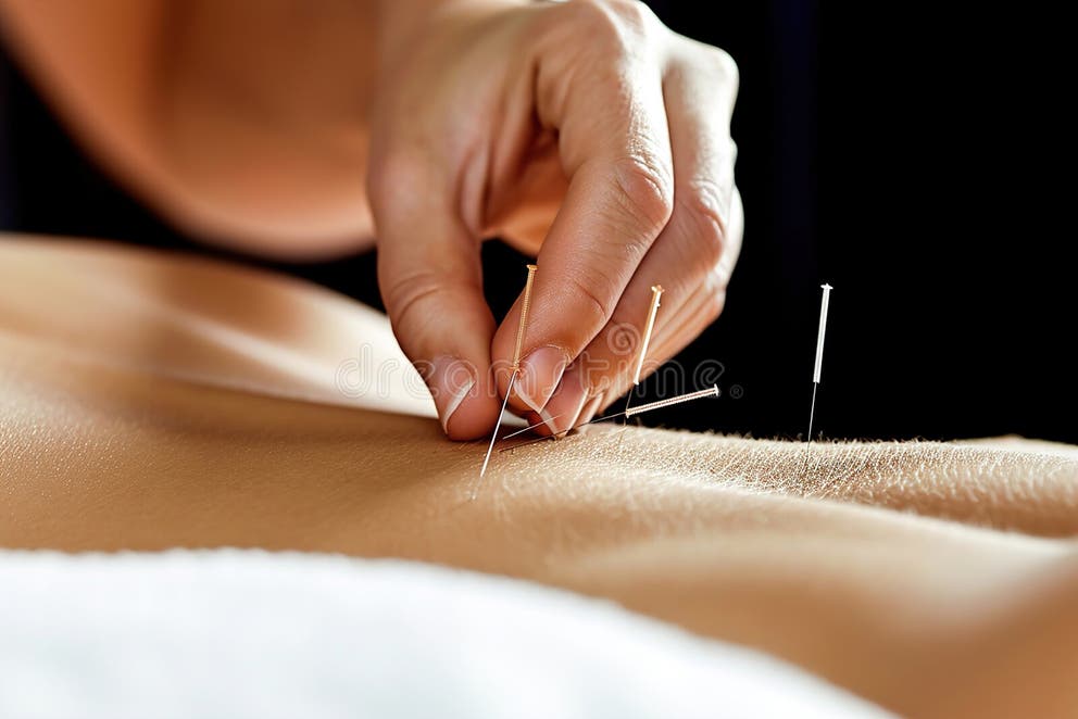 Acupuncture Sessions with Close-ups of the Process on the Body Stock ...