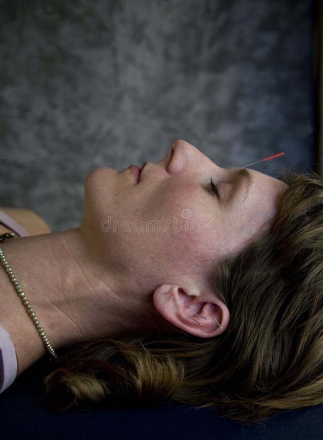 Acupuncture Treatment stock photo. Image of acupuncture - 4355600