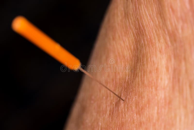 Acupuncture Treatment on Leg Stock Photo - Image of wellness, soft ...