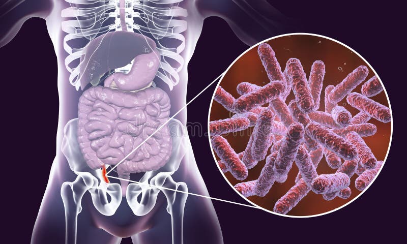 Acute Appendicitis Illustration Stock Illustration Illustration Of