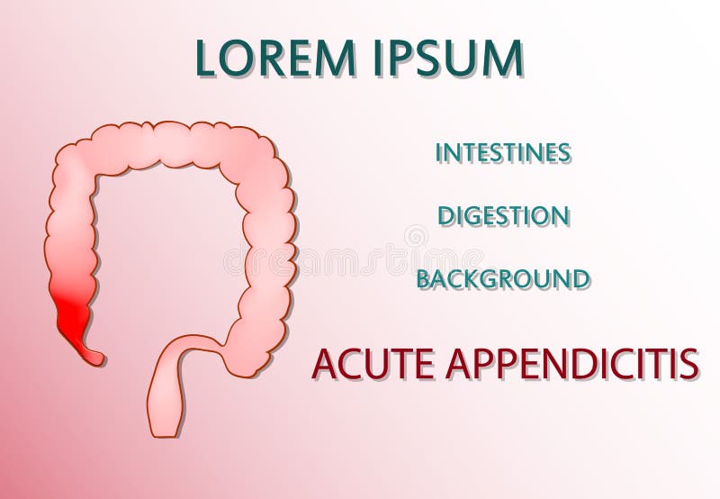 Acute Appendicitis Illustration Stock Illustration - Illustration of ...