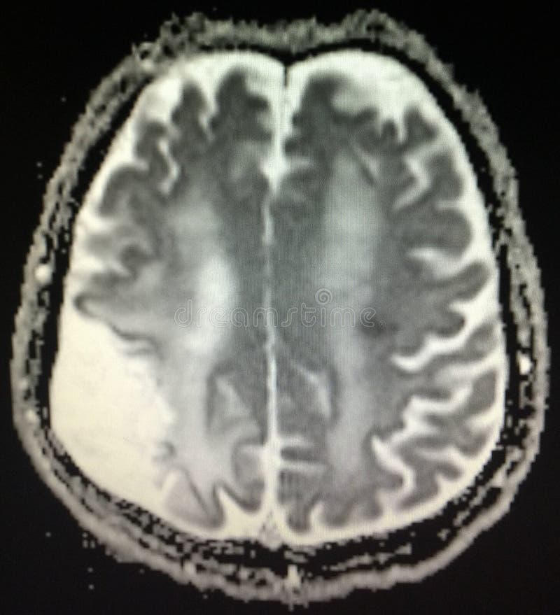 Acute Infarction Brain Mri Examination Stroke Stock Image - Image of ... Acute Infarction Brain Mri Examination Stroke Stock Image - Image of ...