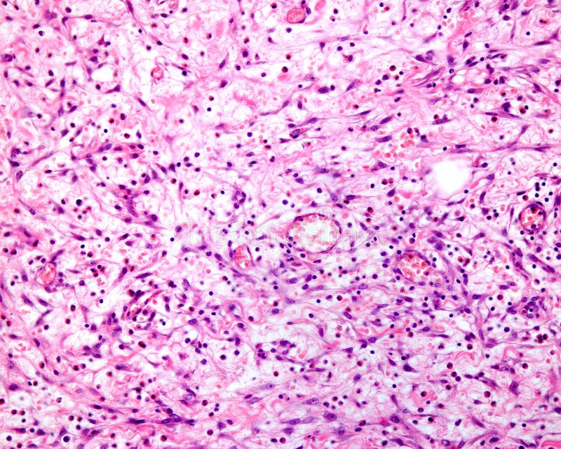 Acute inflammation stock image. Image of muscular, histology - 303146479