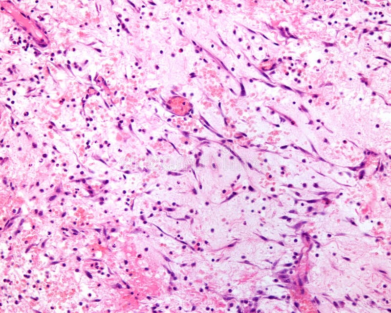 Acute inflammation stock photo. Image of inflamed, microscopic - 303145086