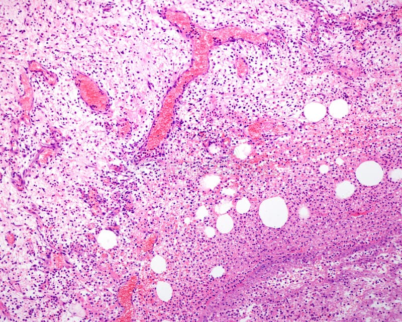 Acute inflammation stock image. Image of microscopic - 303146411