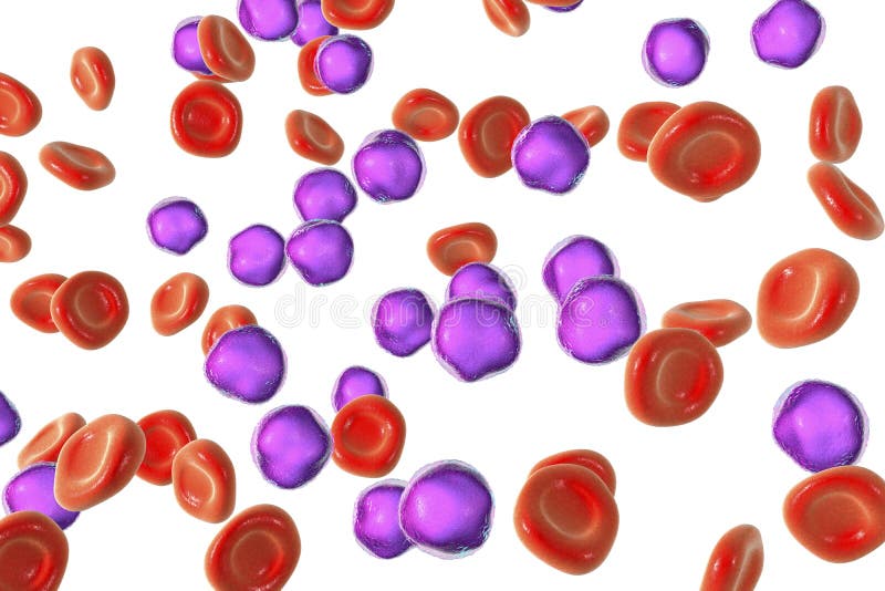 Acute Lymphoblastic Leukemia Stock Illustration - Illustration of ...