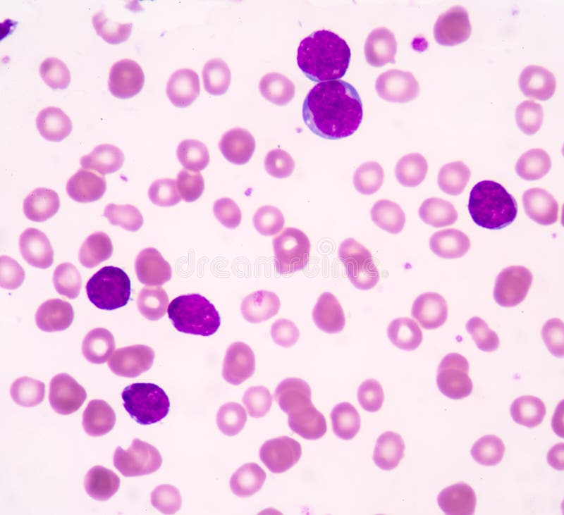 Acute Lymphoblastic Leukemia(ALL) Stock Photo - Image of eosinophil ...