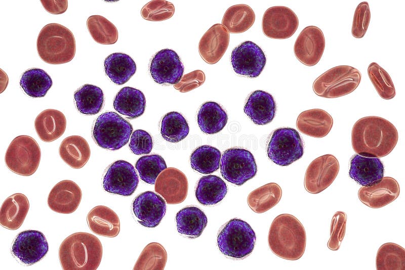 Acute Lymphoblastic Leukemia, Bone Marrow Smear Stock Illustration ...