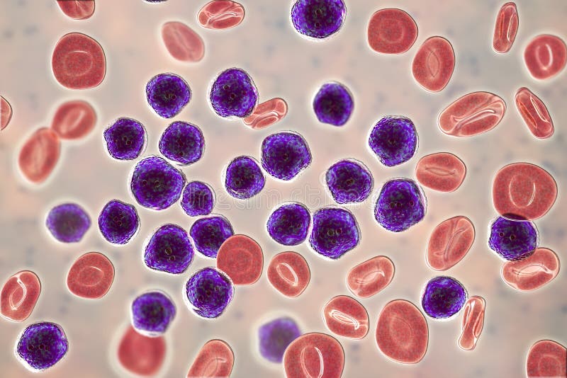 Acute Lymphoblastic Leukemia, Bone Marrow Smear Stock Illustration ...