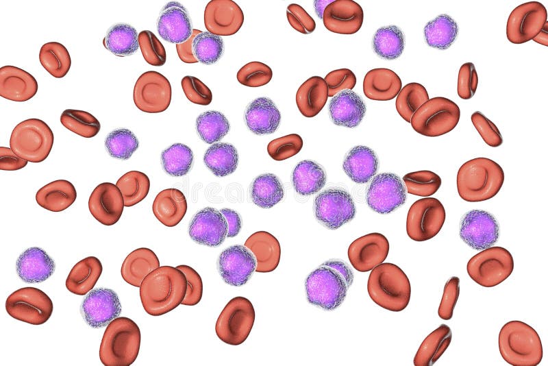 Acute Lymphoblastic Leukemia Stock Illustration - Illustration of ...