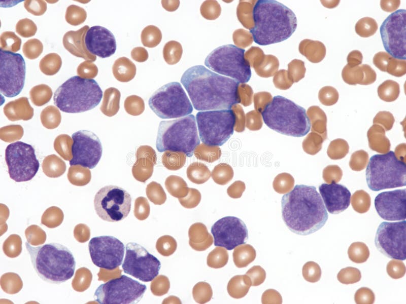 Acute Lymphoid Leukemia. Peripheral Blood. Stock Image - Image of ...