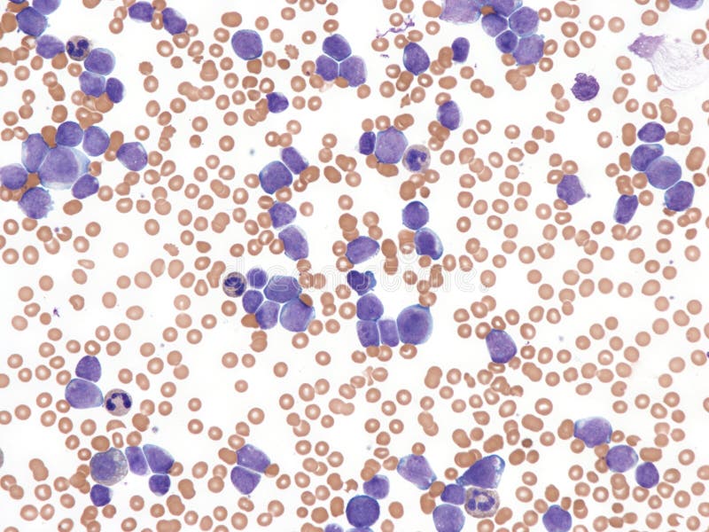 Acute Lymphoid Leukemia. Peripheral Blood. Stock Photo - Image of ...