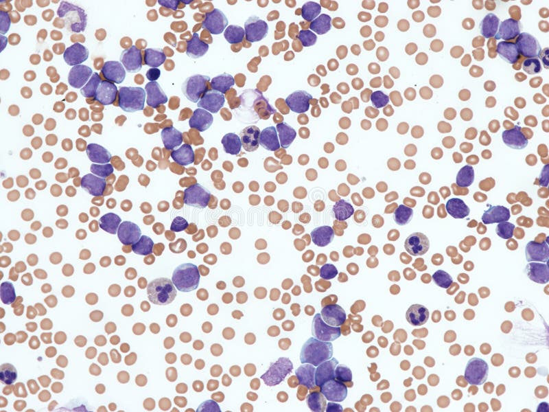 Acute Lymphoid Leukemia. Peripheral Blood. Stock Photo - Image of ...