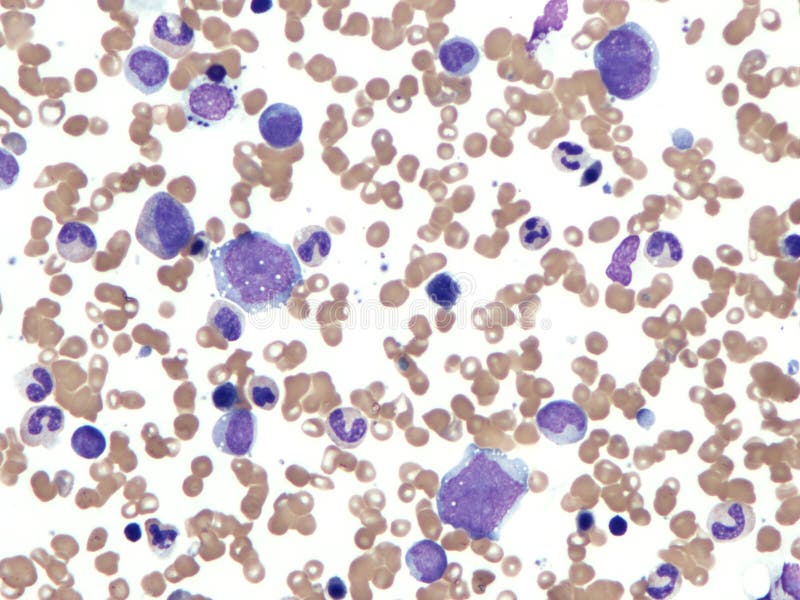 Blast Cells in Acute Myeloid Leukemia. Stock Photo - Image of neurology ...