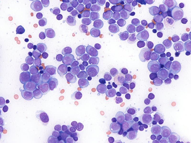 Acute Monocytic Leukemia in Bone Marrow. Stock Image - Image of cancer ...
