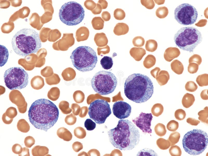 Acute Monocytic Leukemia in Bone Marrow. Stock Photo - Image of cancer ...