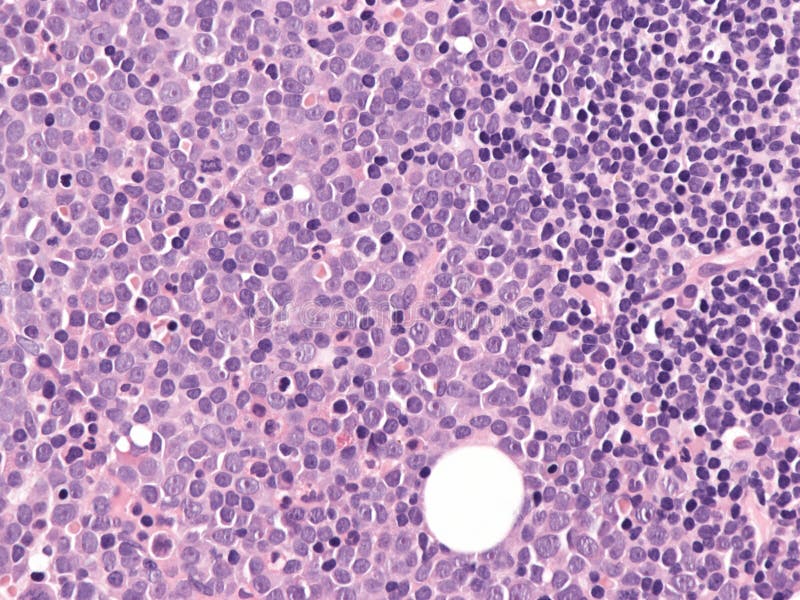 Acute Monocytic Leukemia in Bone Marrow. Histology. Stock Image - Image ...