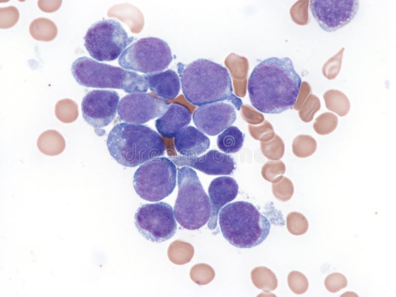Acute Myeloid Leukemia with Proliferation of Dendritic Cells. Stock ...