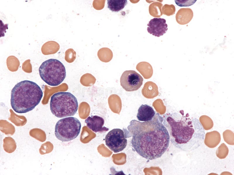 Acute Myelomonocytic Leukemia in Bone Marrow. Stock Image - Image of ...