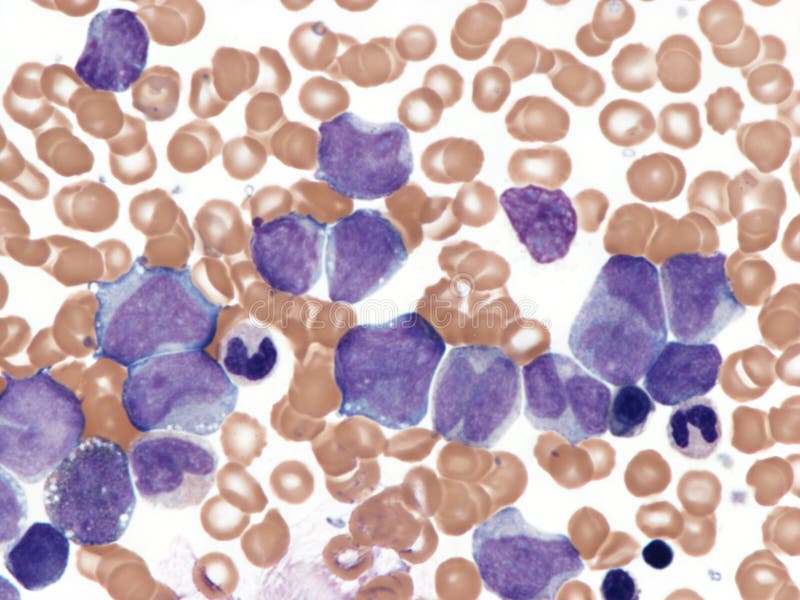 Acute Myelomonocytic Leukemia with Hyperleukocytosis. Stock Photo ...