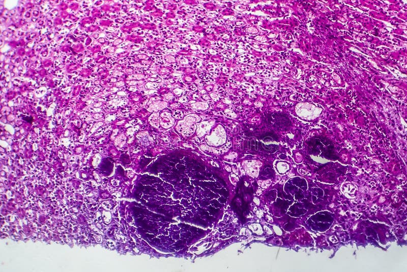 Acute Nephritis, Light Micrograph Stock Photo - Image of cell ...