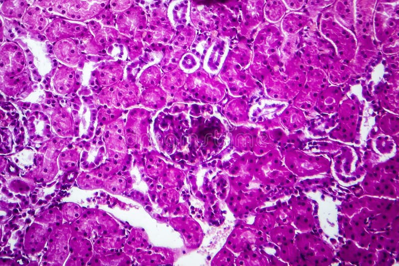 Acute Nephritis, Light Micrograph Stock Photo - Image of inflammation ...