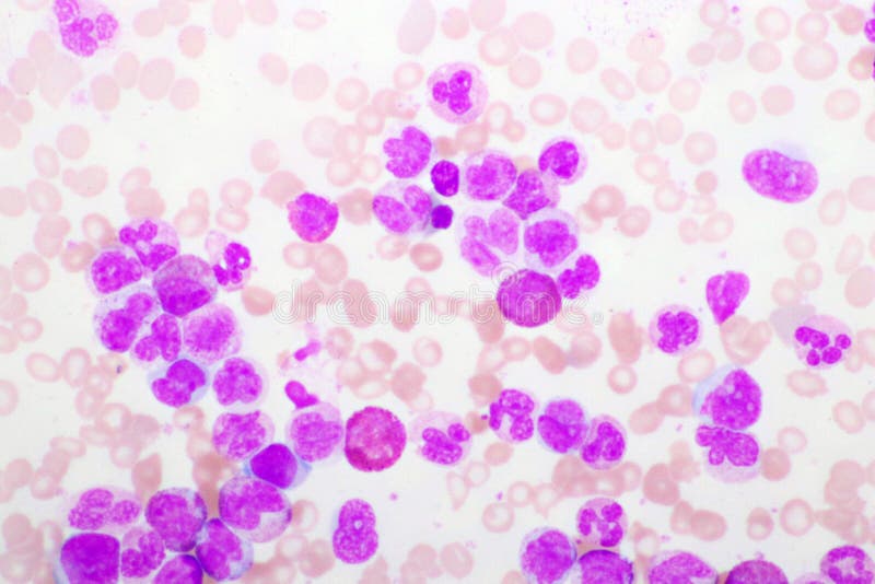 Acute Promyelocytic Leukemia Cells Stock Photo - Image of cell, analyze ... Acute Promyelocytic Leukemia Cells Stock Photo - Image of cell, analyze ...