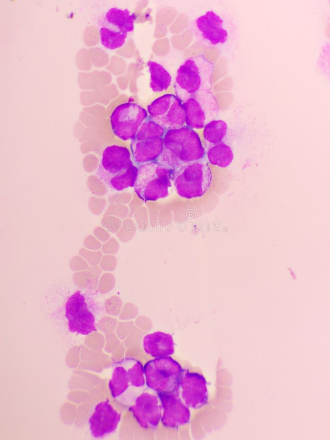 Acute Promyelocytic Leukemia Cells or APL Stock Photo - Image of ...