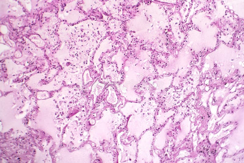 Acute pulmonary edema stock photo. Image of alveolus - 120905272