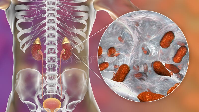 Concept of Pyelonephritis, Diseases and Kidney Stones, Cystitis, Stock ...