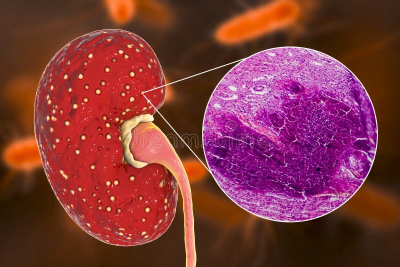 Acute Pyelonephritis, Gross Morphology and Histopathology Stock ... Acute Pyelonephritis, Gross Morphology and Histopathology Stock ...