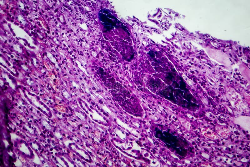 Acute Pyelonephritis, Light Micrograph Stock Image - Image of histology ...