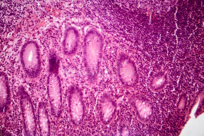 Acute Simple Appendicitis, Light Micrograph Stock Illustration ...