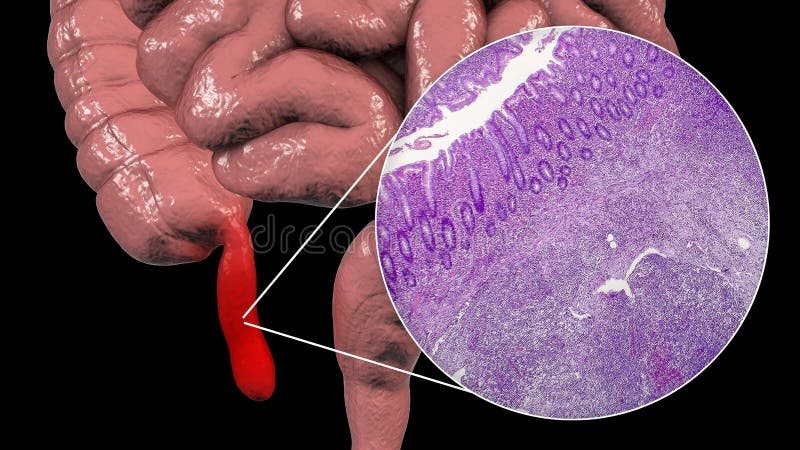 Acute Suppurative Appendicitis, Illustration and Light Micrograph Stock ...