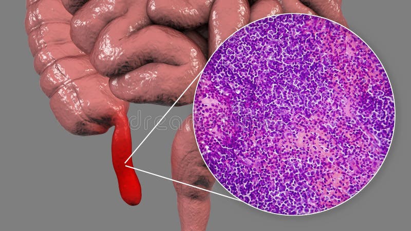 Acute Suppurative Appendicitis, Illustration and Light Micrograph Stock ...