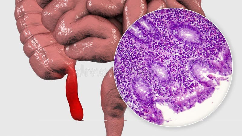 Acute Suppurative Appendicitis Illustration And Light Micrograph Stock