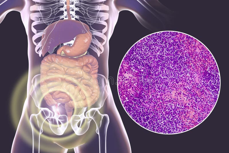 Acute Suppurative Appendicitis, Illustration and Light Micrograph Stock ...