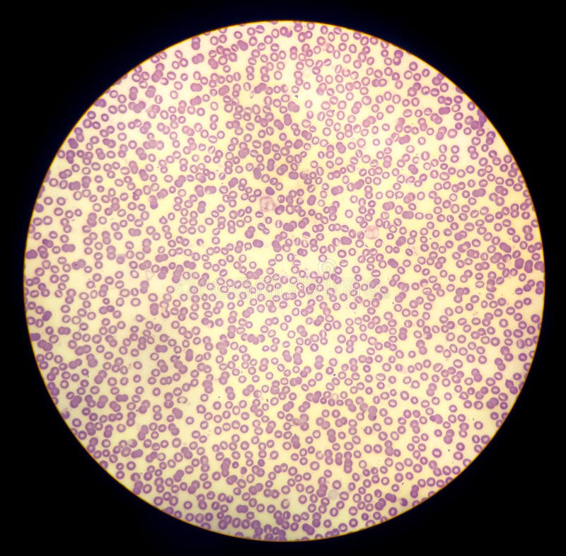 Acute Thrombocytopenia and Leukocytopenia with Normal RBC. Stock Image ...