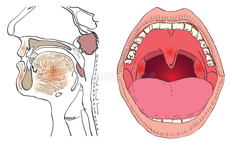 Adenoideo Adenoide Normale Ed Ingrandetta Illustrazione Vettoriale ...