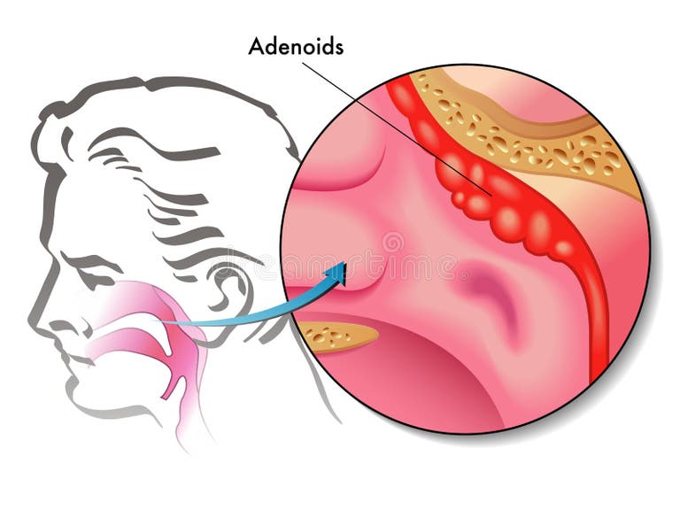 Adenoids Tonsils Stock Illustrations – 60 Adenoids Tonsils Stock ...
