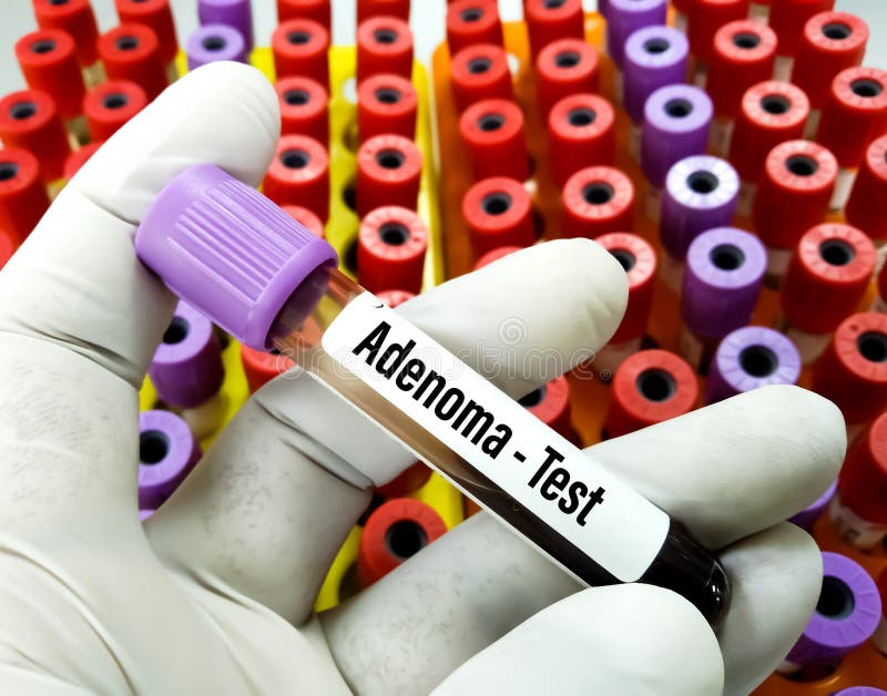 Blood Sample for Adenoma Test. Stock Photo - Image of ketones, dystest ...