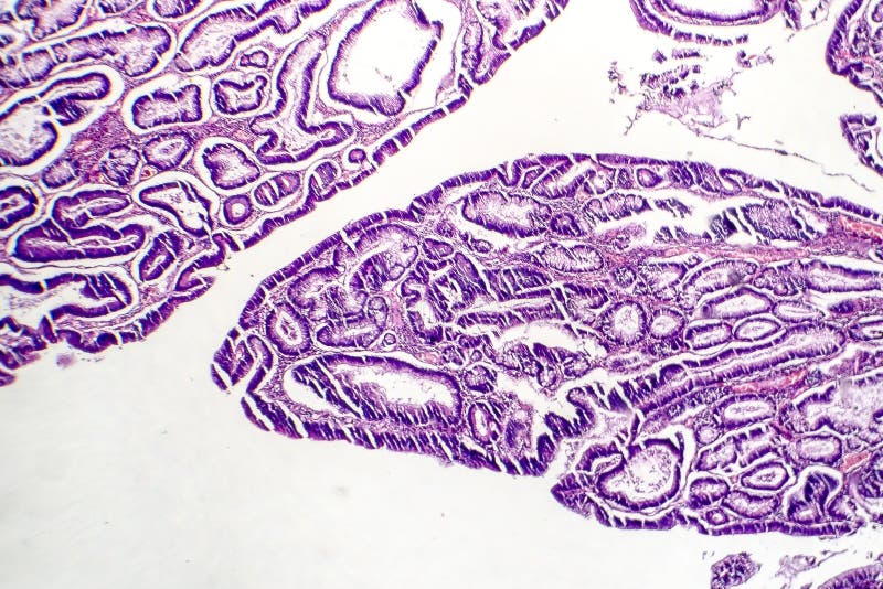 Adenoma Polypoid Intestinal Foto de Stock - Imagem de médico, benigno ...