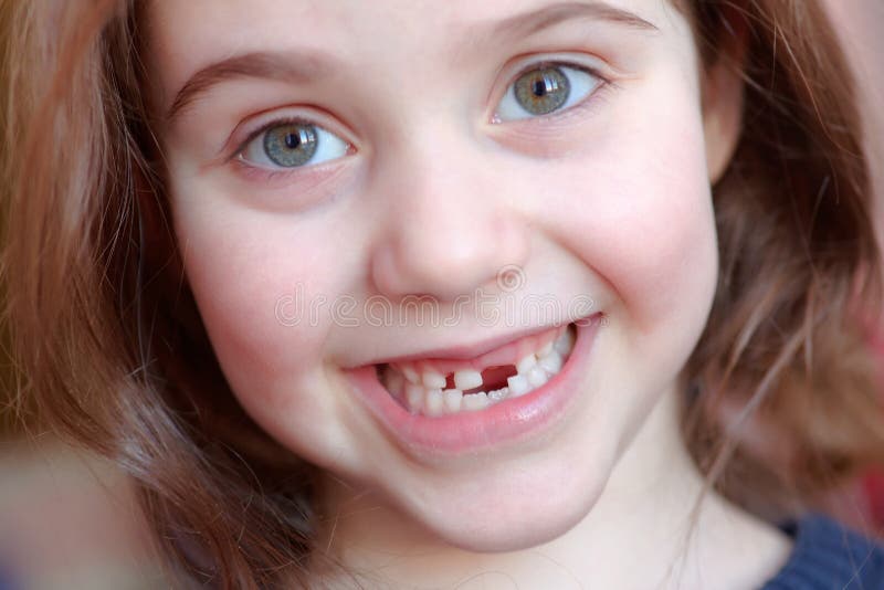 The Adorable Girl Smiles with the Fall of the First Baby Teeth. Stock ...
