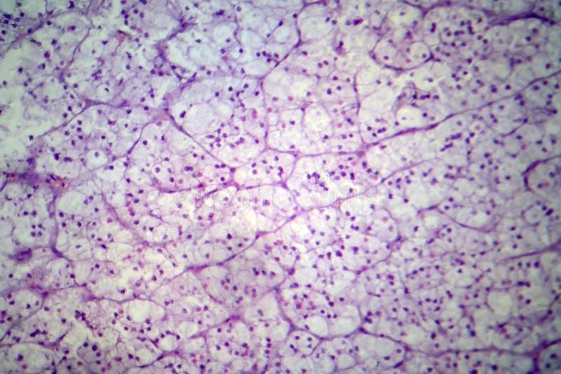 Adrenocortical Adenoma, Light Micrograph Stock Photo - Image of ...