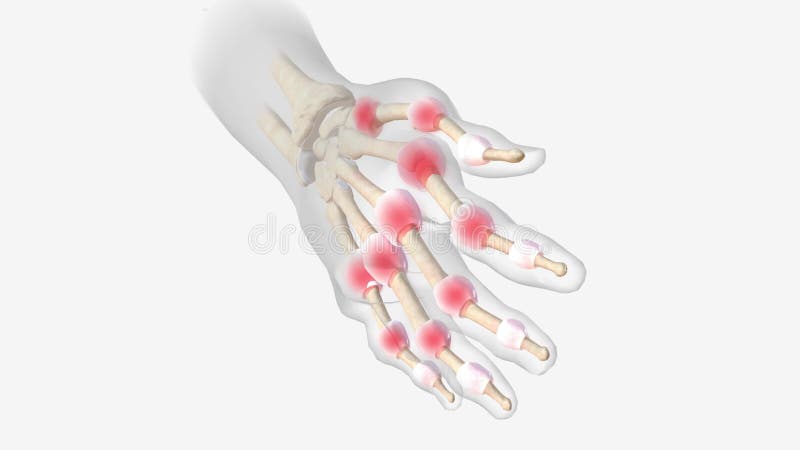 Pain in the Arthritic Knee Joint, Knee Painful, Skeleton X-ray ...