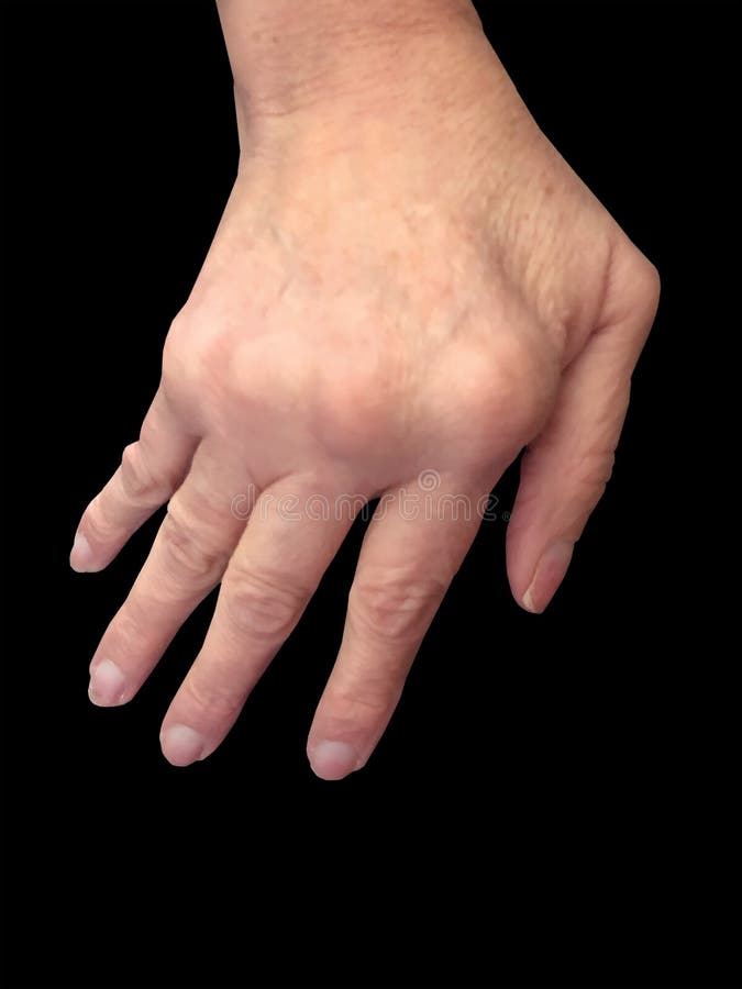 Advanced Rheumatoid Arthritis Effects on Hands Stock Photo - Image of ...