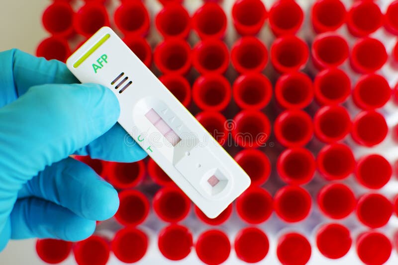 AFP positive stock image. Image of analyzing, tube, patient - 57034553