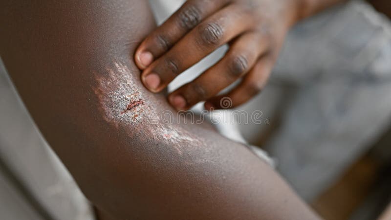 African American Man Sitting on Sofa Touching Wound on Arm at Home ...