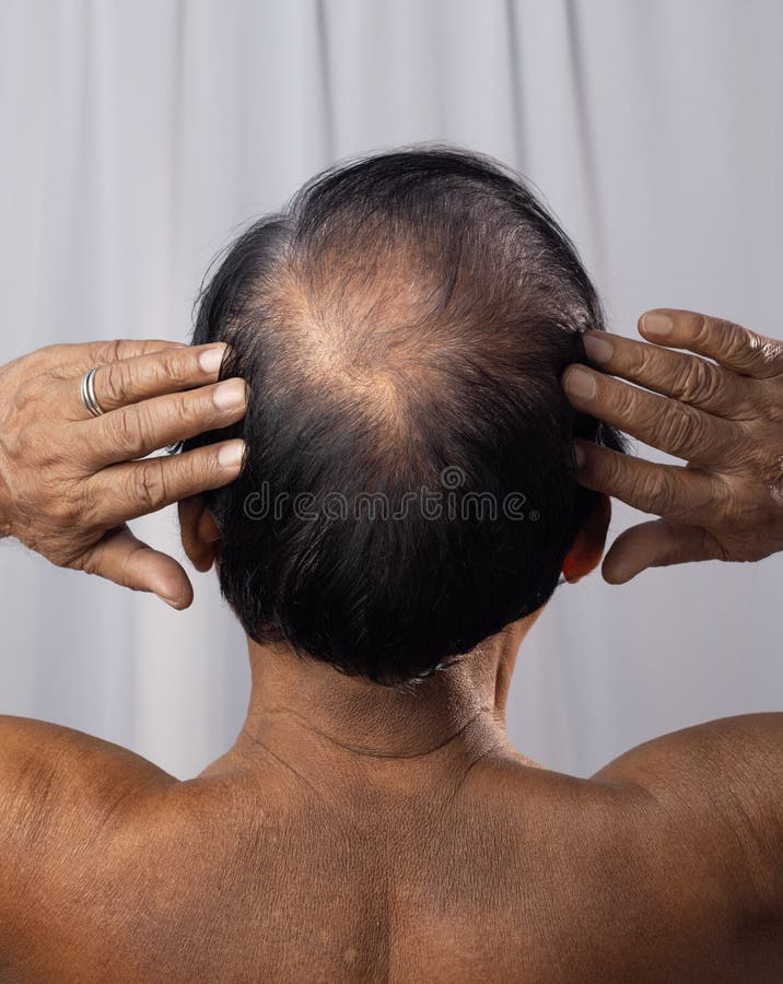 Man Facing Hair Fall Problem Sketch Drawing, Hair Loss Vector ...