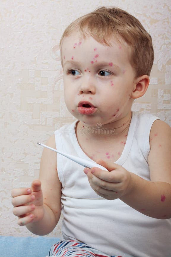 Ailing child stock image. Image of ailing, sick, urticaria - 23285567